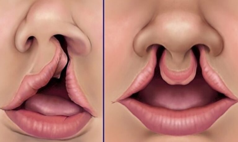 Cleft Lip and Cleft Palate – Bright Smile Dental Hospital